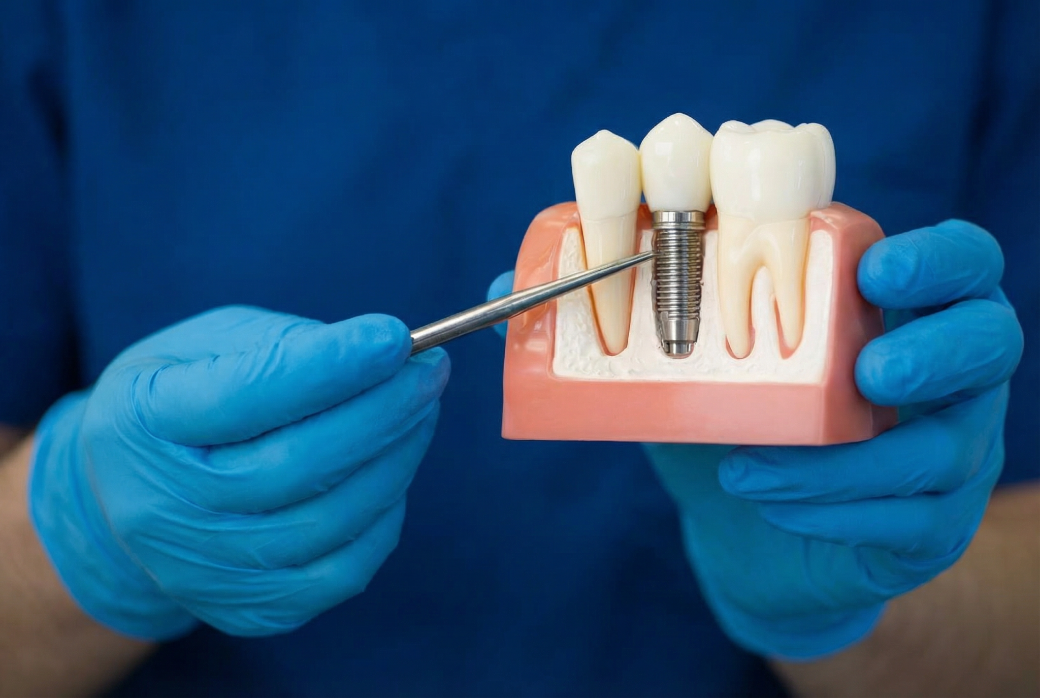 Dental Implants Explained: Assessment, Bone Support, and Long-Term Care ...